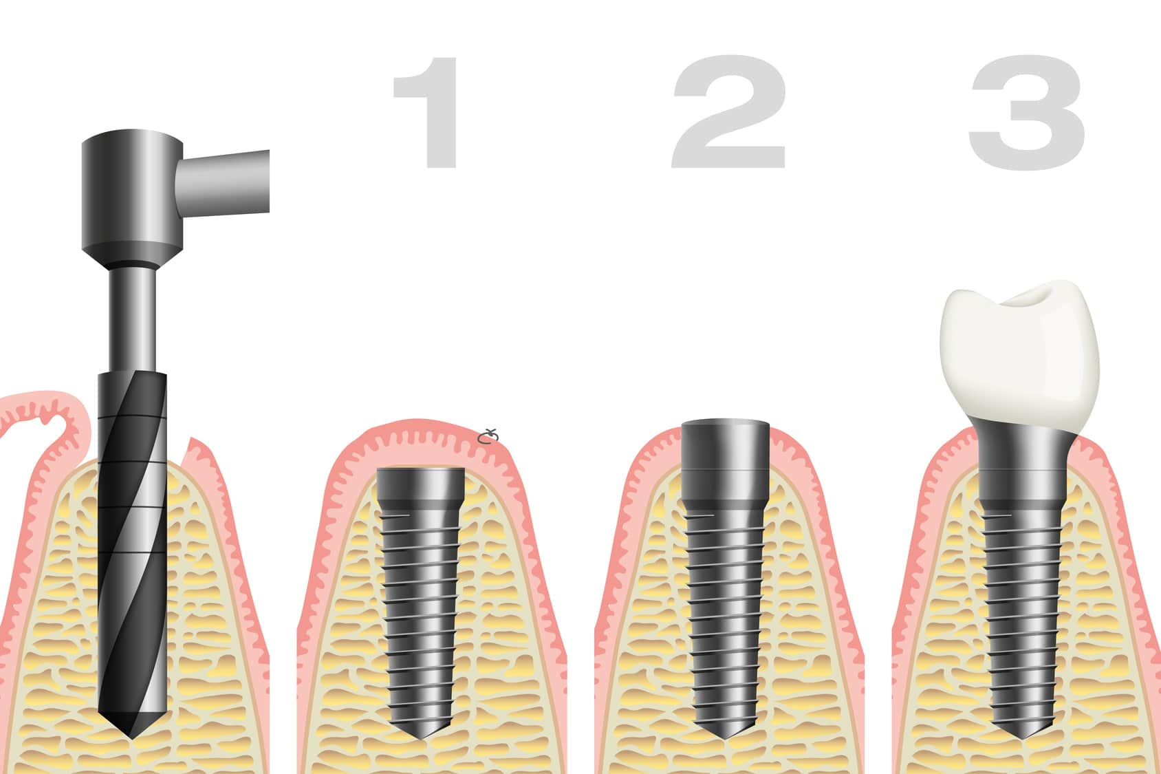 Discover the Evolution of Dental Implants | Irvine Dentists